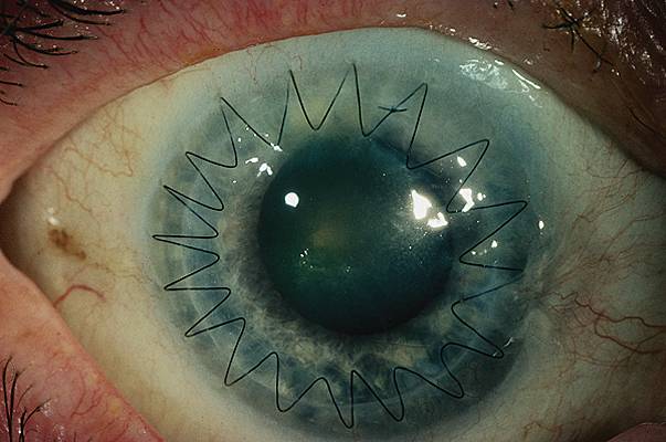 Greffe de cornée - institut ophtalmologique Sourdille Atlantique